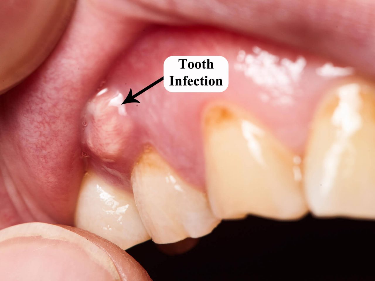 What to know about antibiotics and tooth infections - Dana Dental